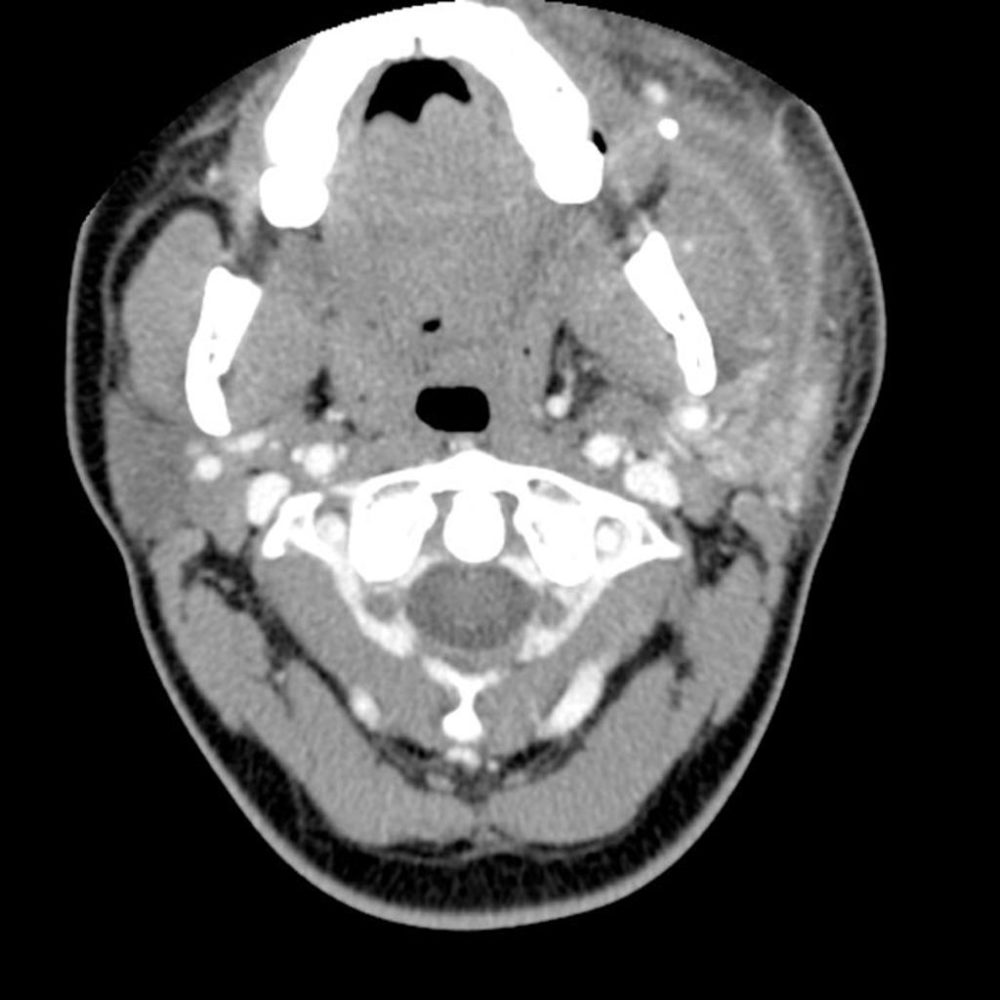 Pathologies - Afshin Yousefpour | Parotidéctomie Bruxelles